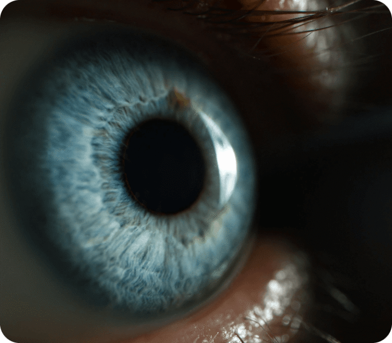 Laser Peripheral Iridotomy (LPI) - EyeHub